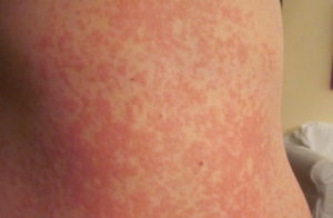 A Natural Cure for Mono | Entri Ways